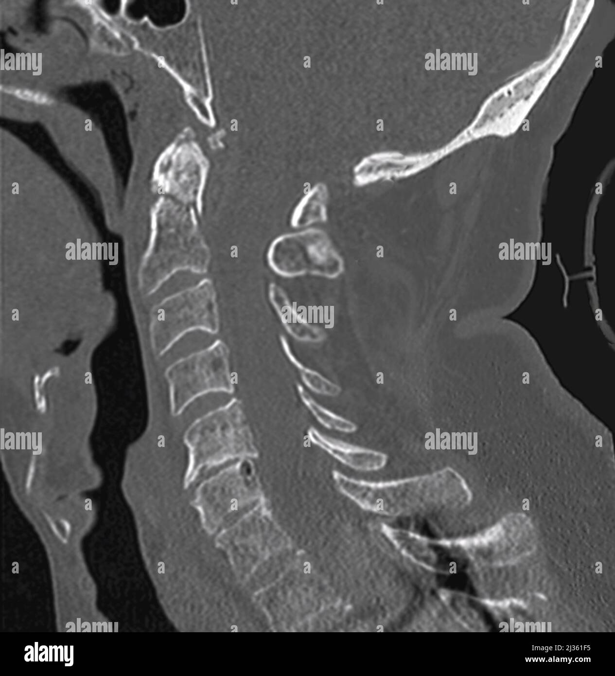 Fractured cervical vertebra, CT scan Stock Photo - Alamy