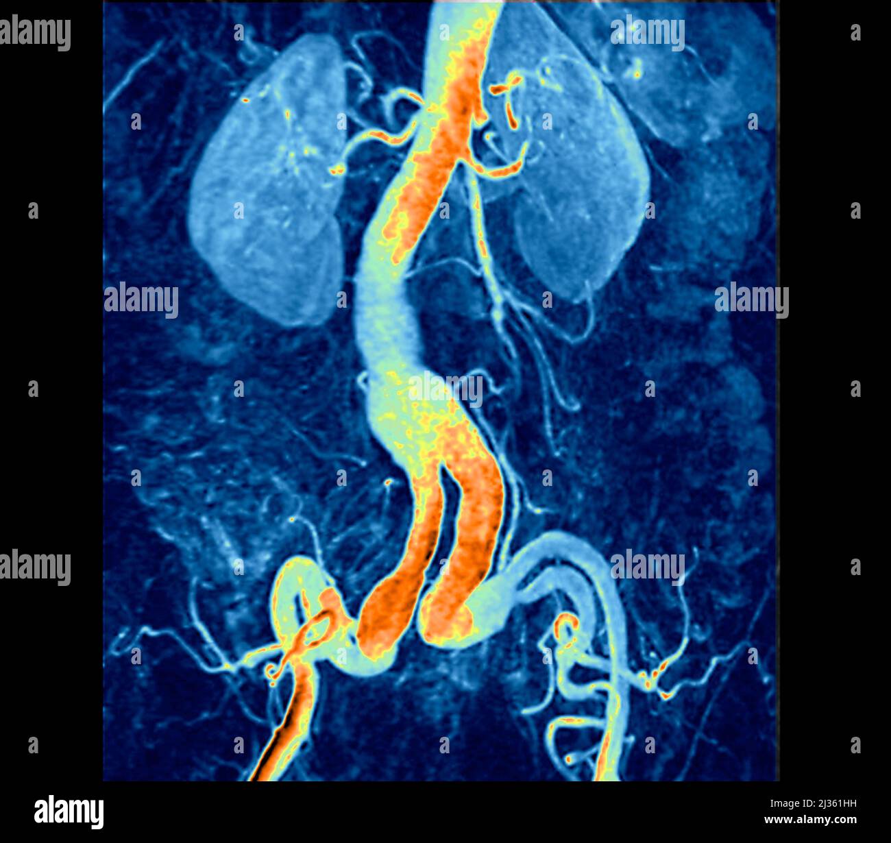 Aneurysm of iliac and renal arteries, MRI angiogram Stock Photo - Alamy