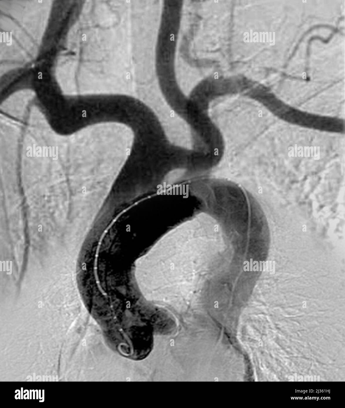 Aortic aneurysm, angiogram Stock Photo - Alamy