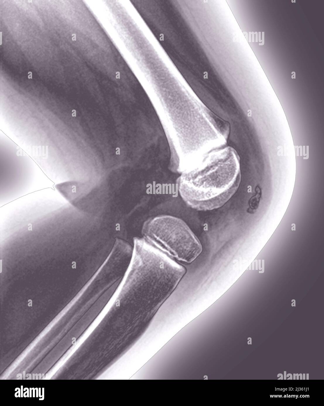 Knee of a child, X-ray Stock Photo - Alamy