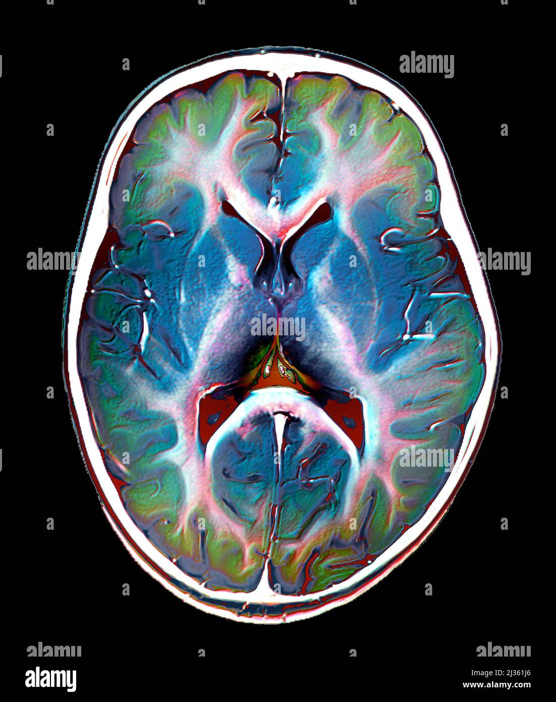 Healthy brain, MRI scan Stock Photo - Alamy