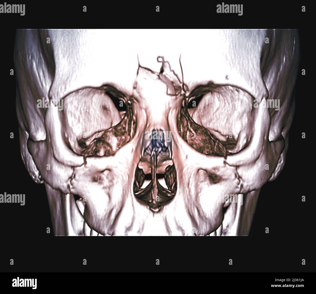 Le Fort skull fractures, CT scan Stock Photo - Alamy