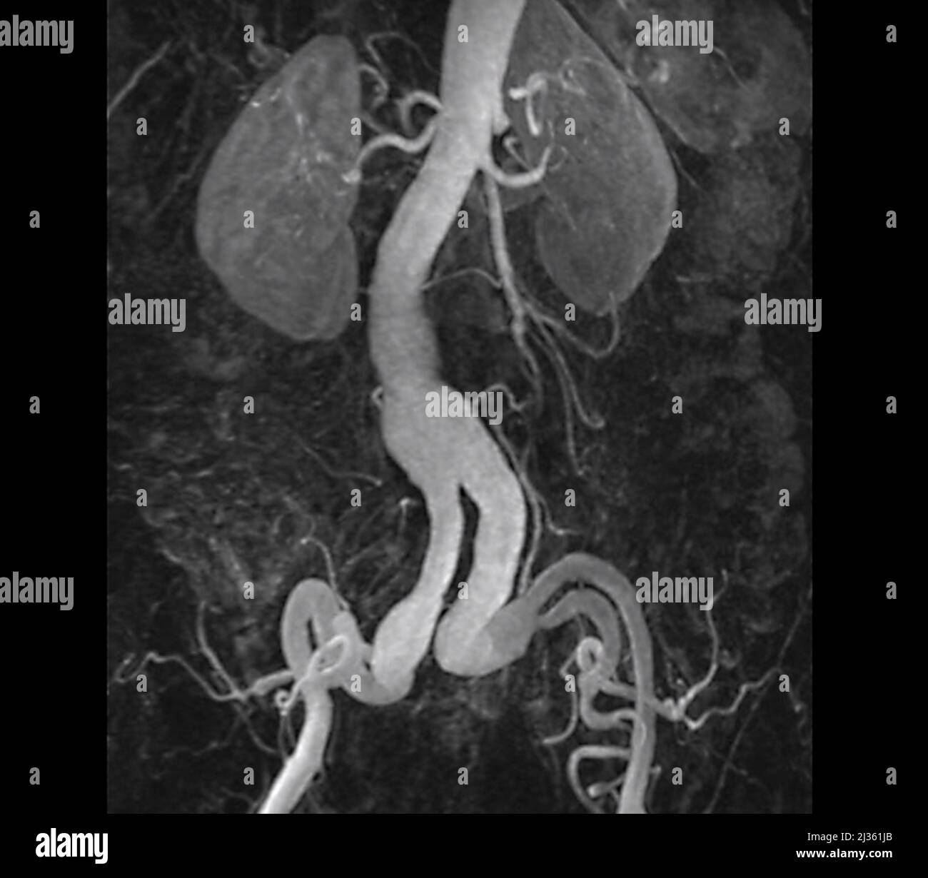 Aneurysm of iliac and renal arteries, MRI angiogram Stock Photo - Alamy