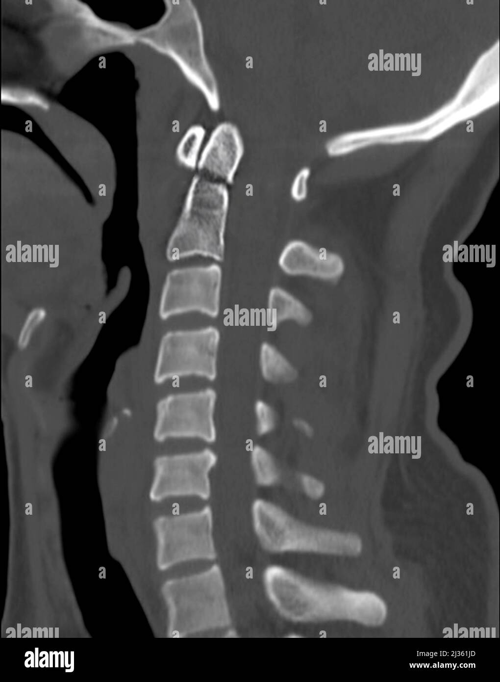 Odontoid Process Fracture