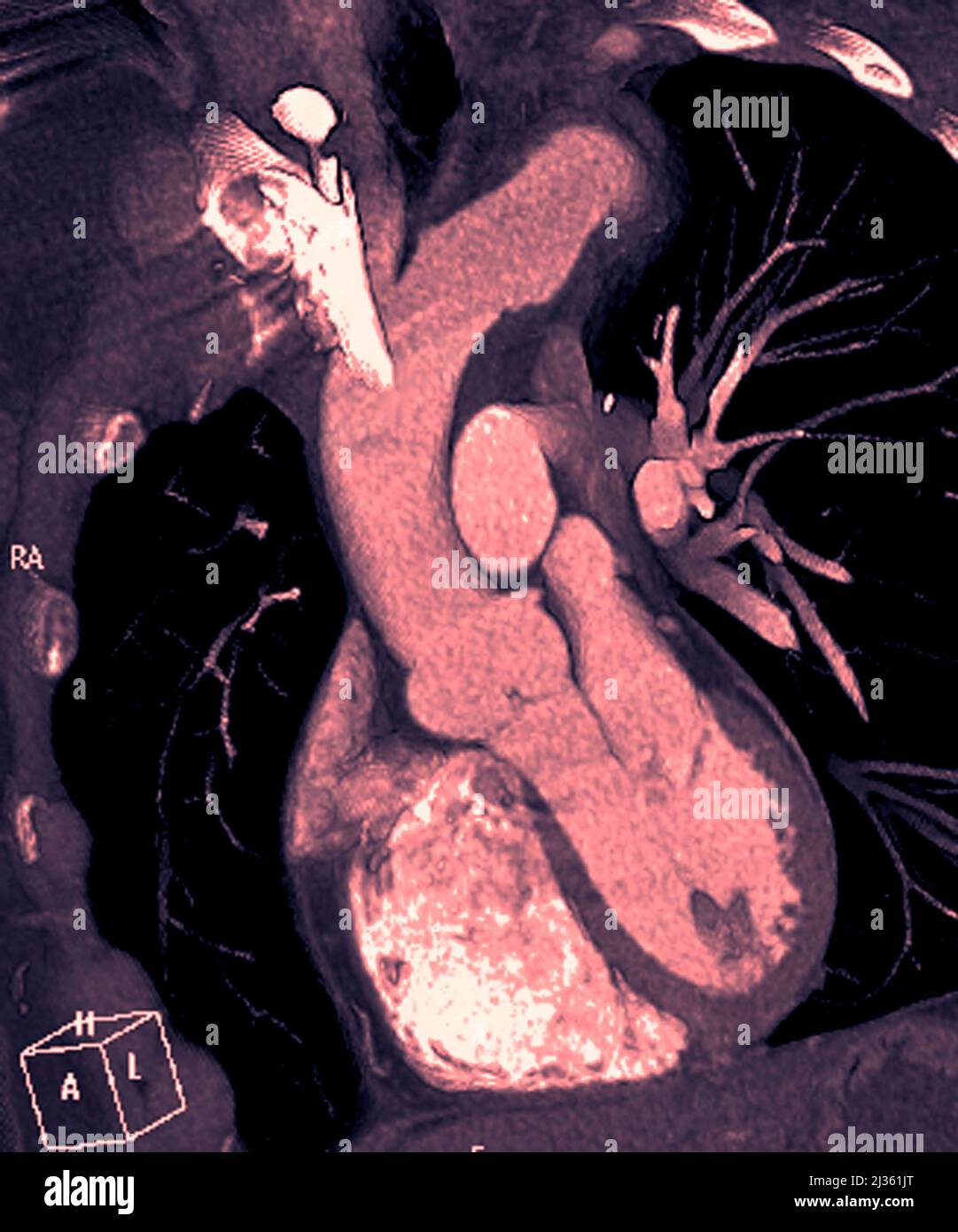 Healthy aortic valve, angiogram Stock Photo - Alamy