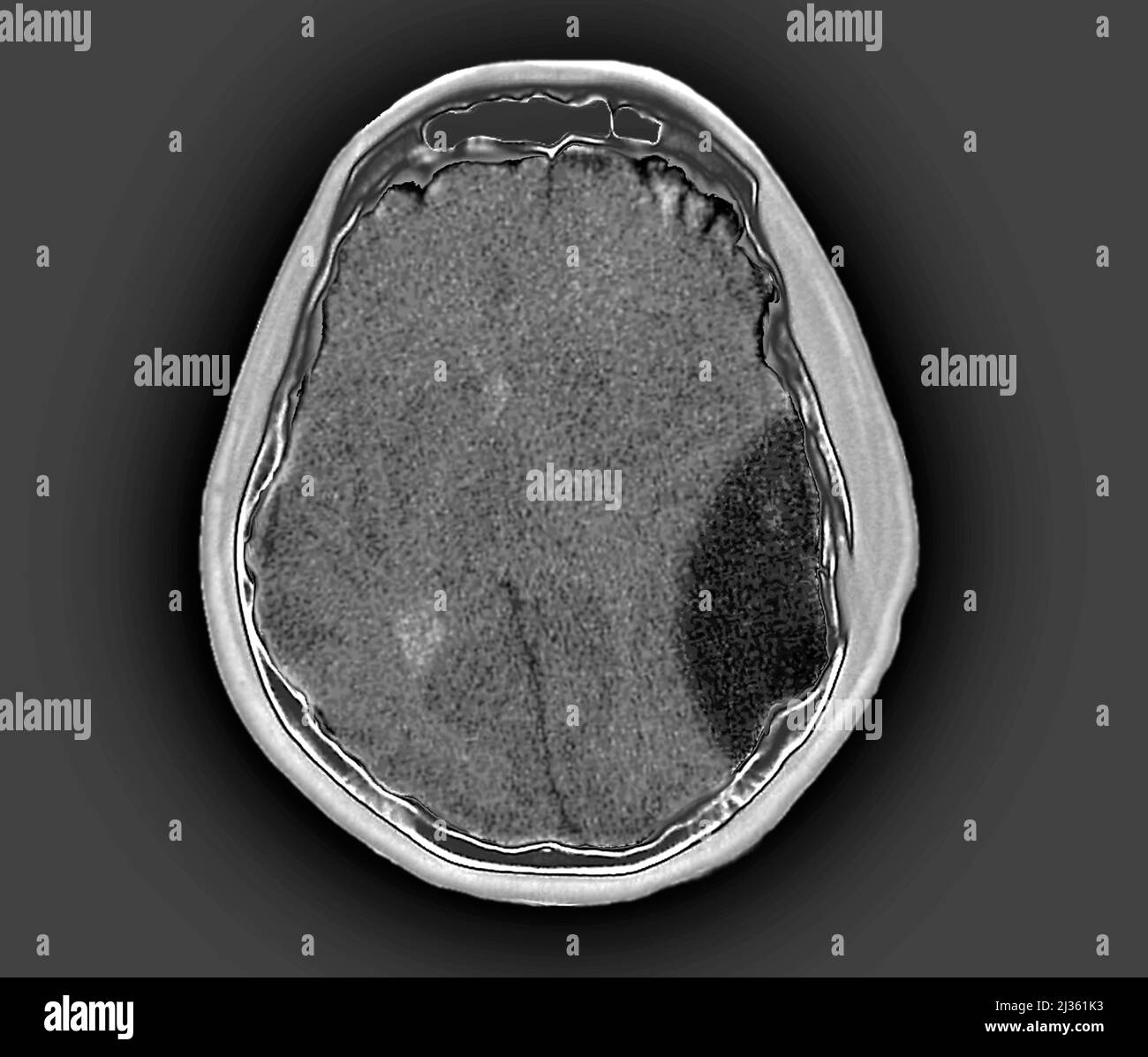 Skull fracture, CT scan Stock Photo - Alamy