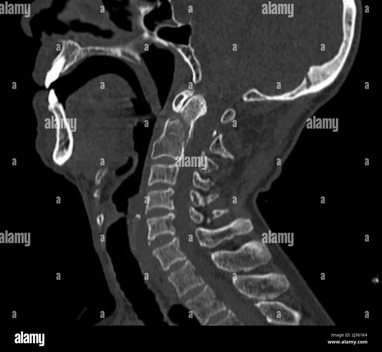 Odontoid process fracture, CT scan Stock Photo - Alamy