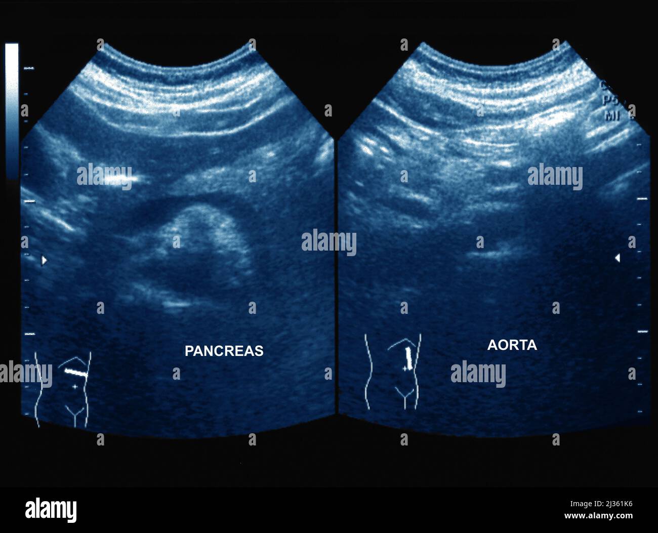 Normal pancreas and aorta, ultrasound scans Stock Photo - Alamy