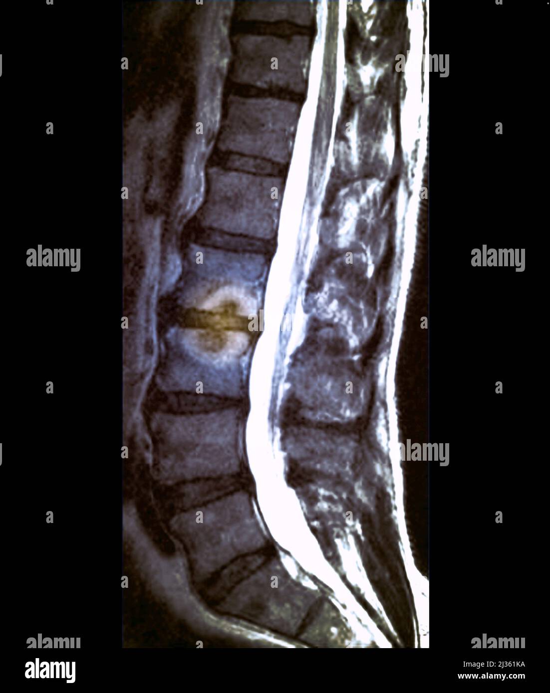 Nódulos De Schmorl é Grave - RETOEDU