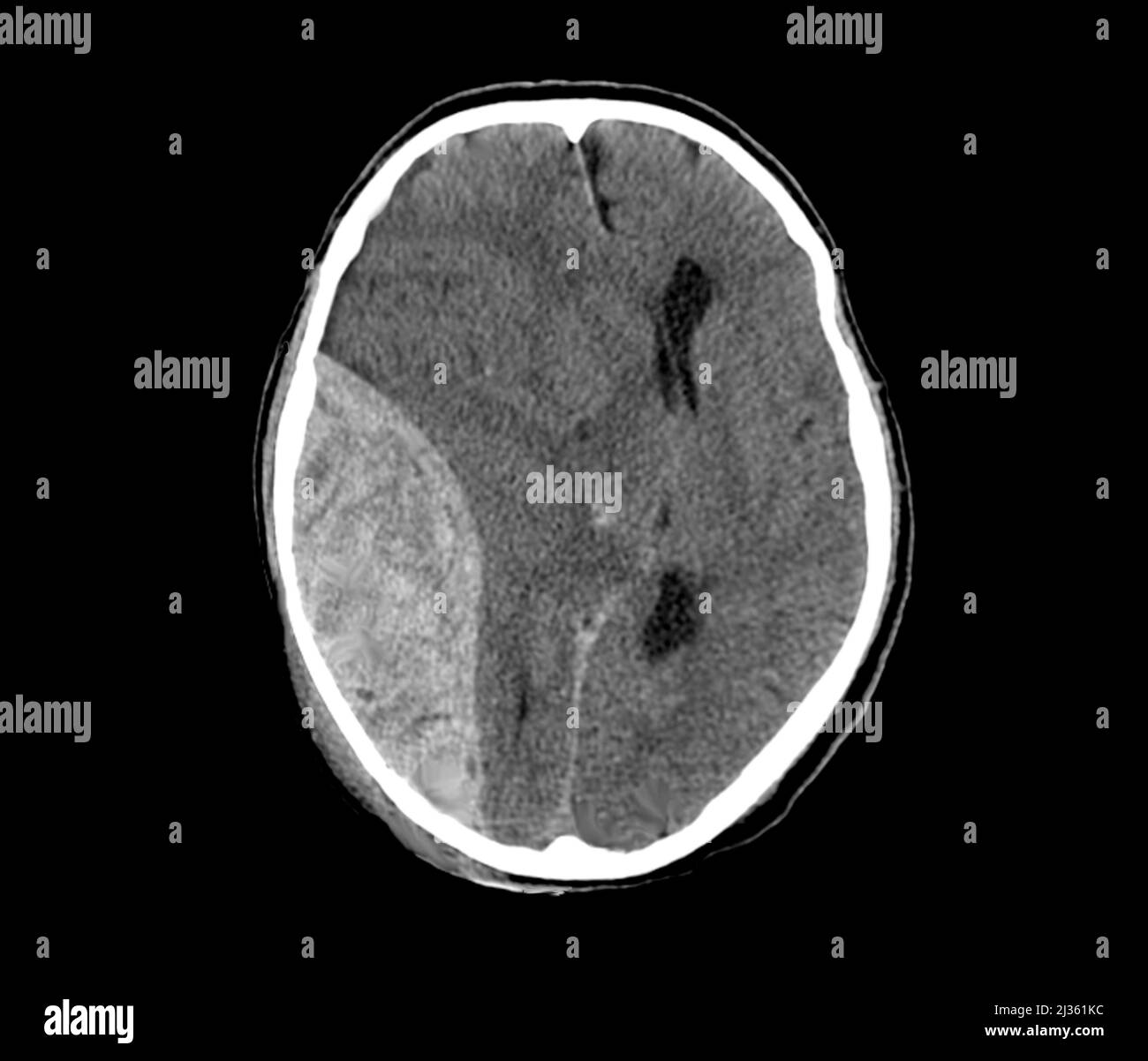 Extradural haematoma, CT scan Stock Photo - Alamy