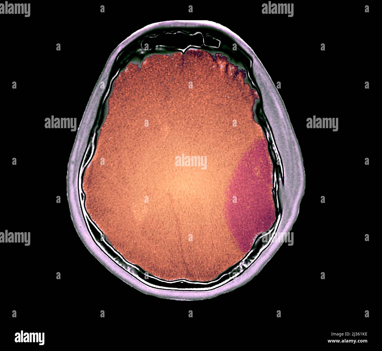Skull fracture, CT scan Stock Photo - Alamy