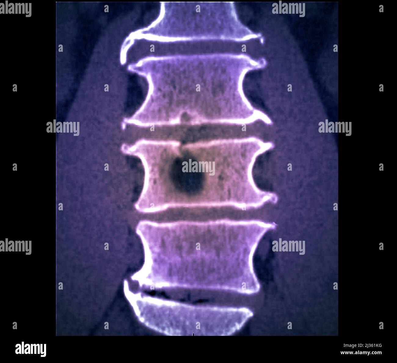 Schmorl's node, CT scan Stock Photo - Alamy