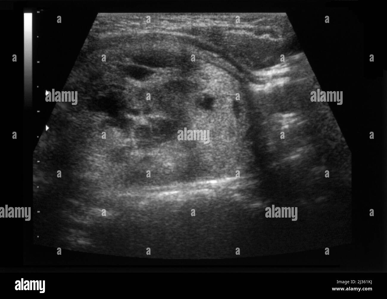 Thyroid nodule, ultrasound scan Stock Photo - Alamy
