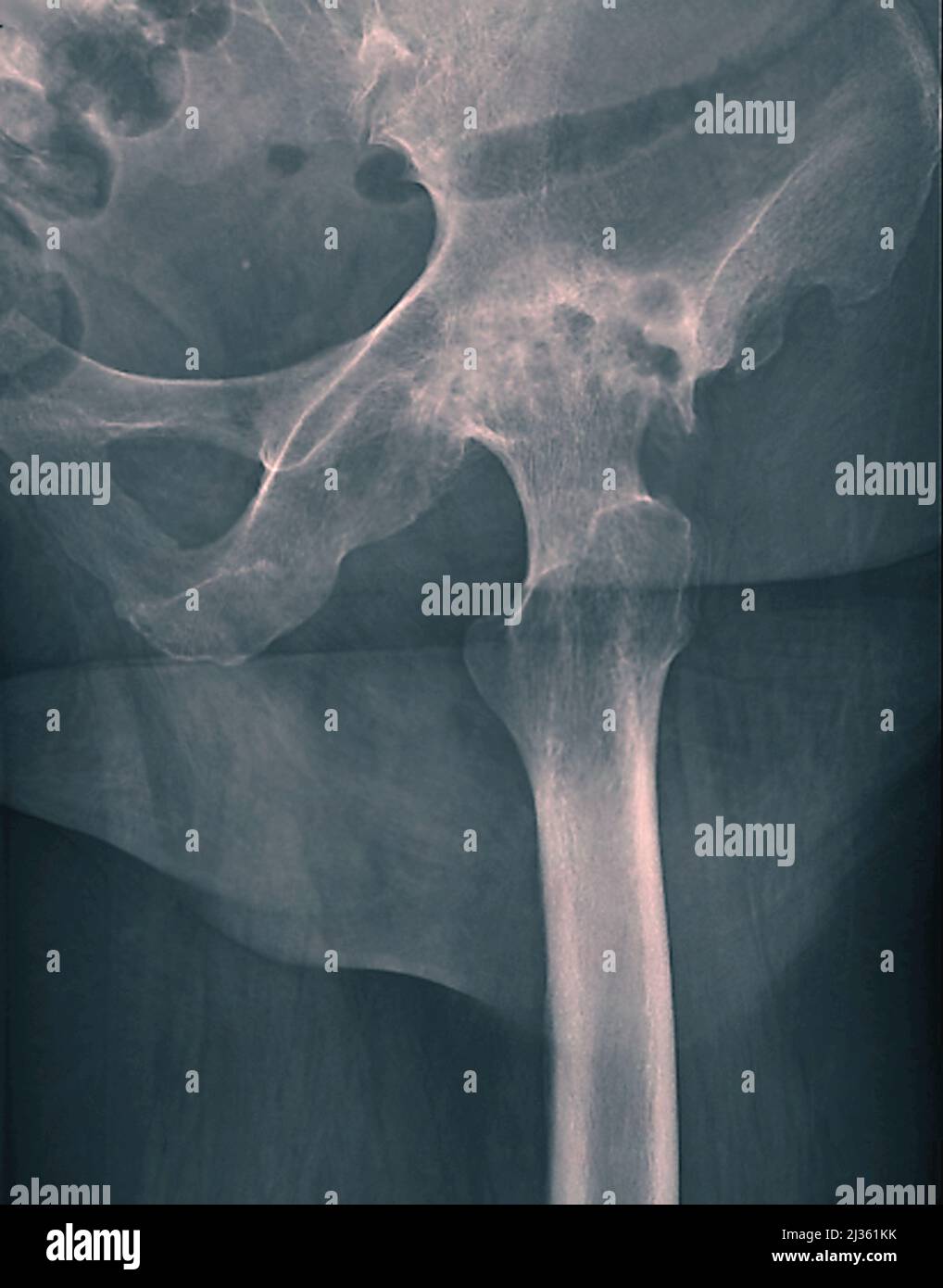 Osteoarthritis of the hip, X-ray Stock Photo - Alamy