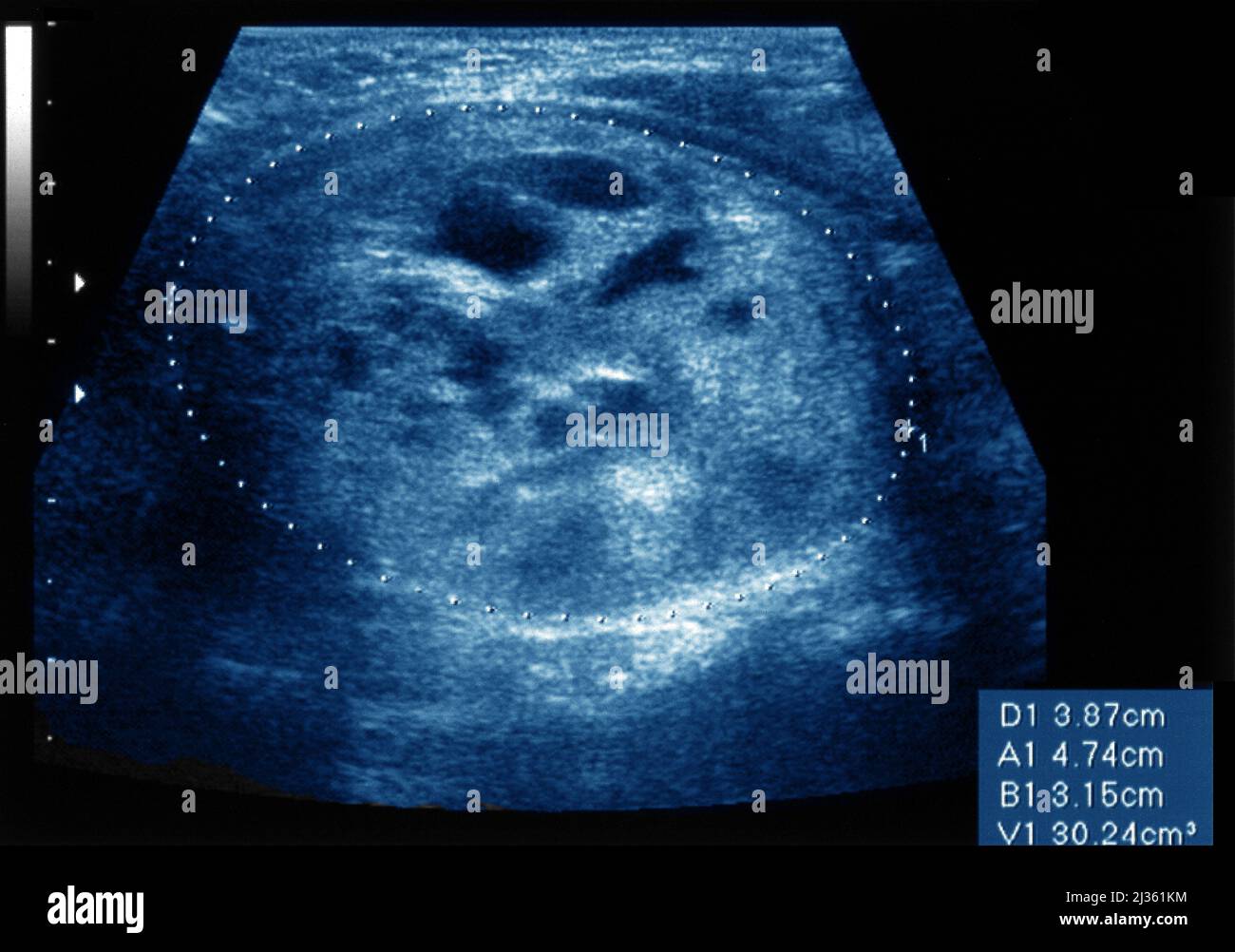 Thyroid nodule, ultrasound scan Stock Photo - Alamy