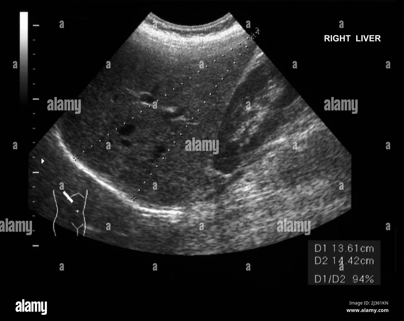 Normal liver, ultrasound scan Stock Photo - Alamy