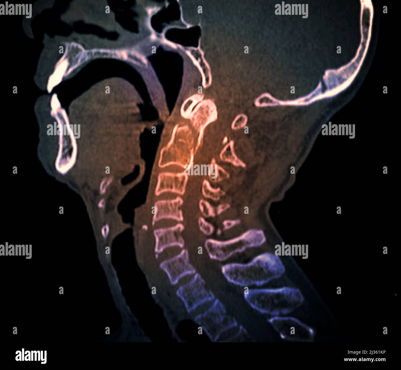 Odontoid process fracture, CT scan Stock Photo - Alamy