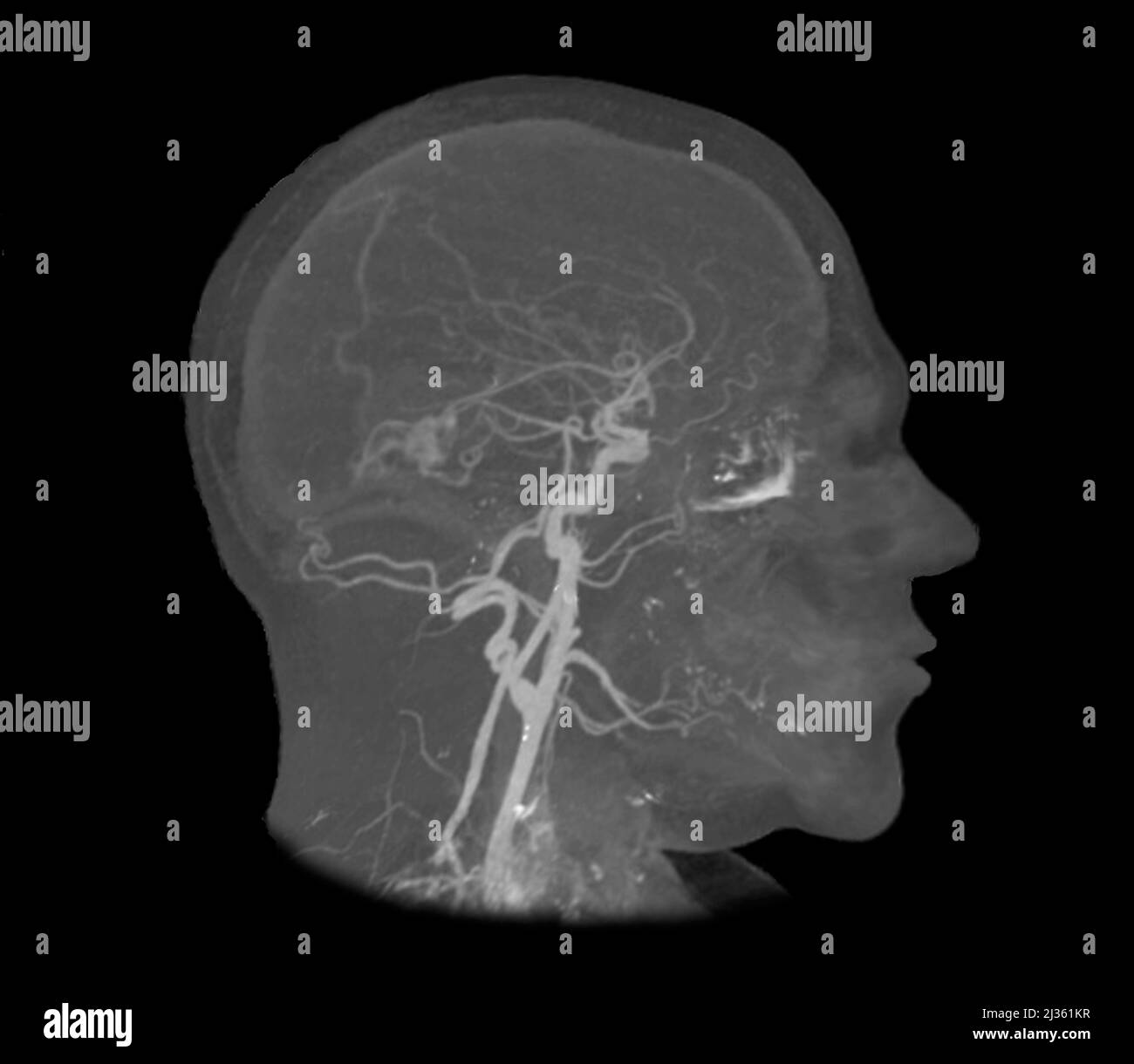 Brain haemorrhages, MRI angiogram Stock Photo - Alamy