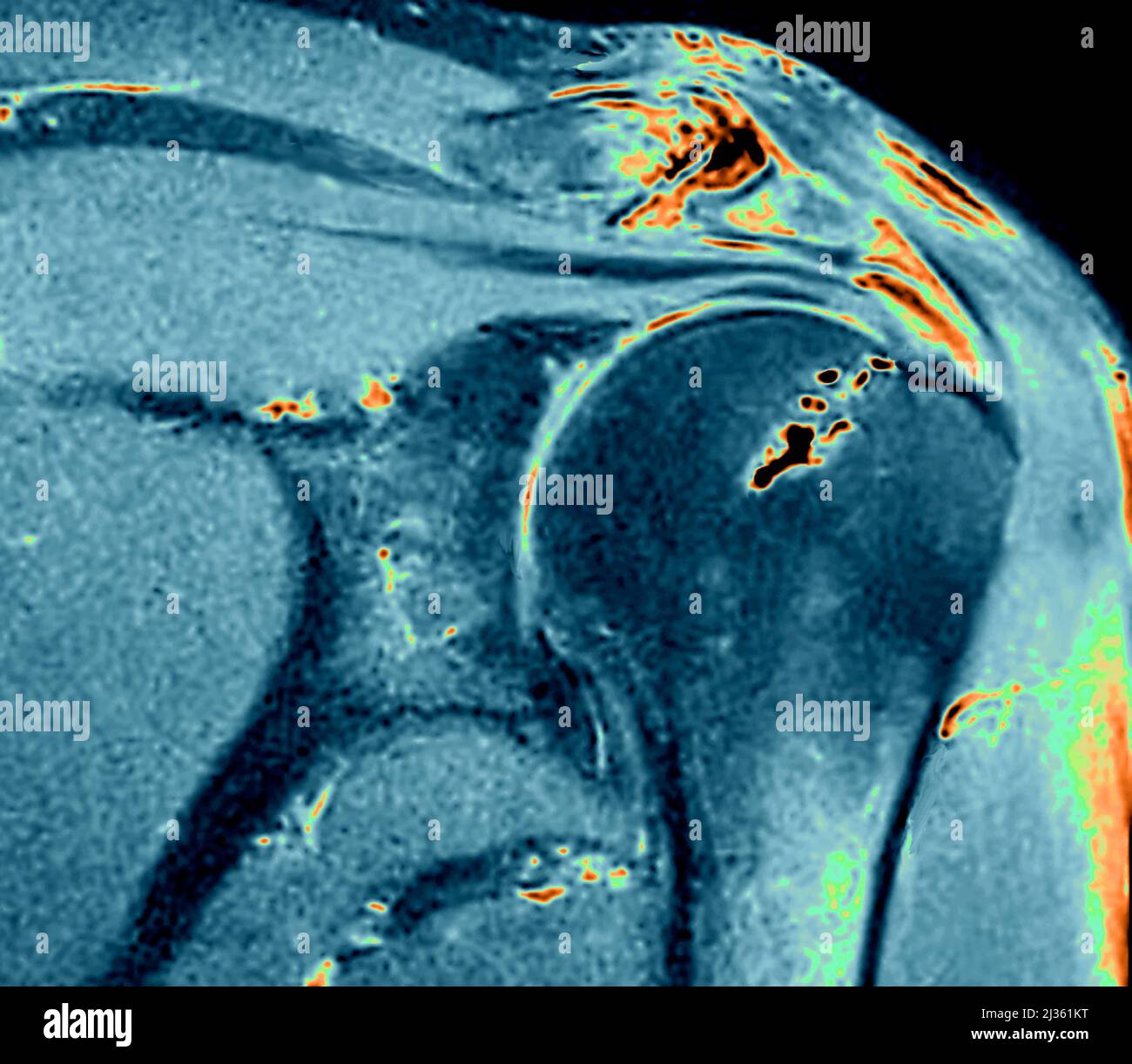 Calcified tendinitis, MRI scan Stock Photo - Alamy