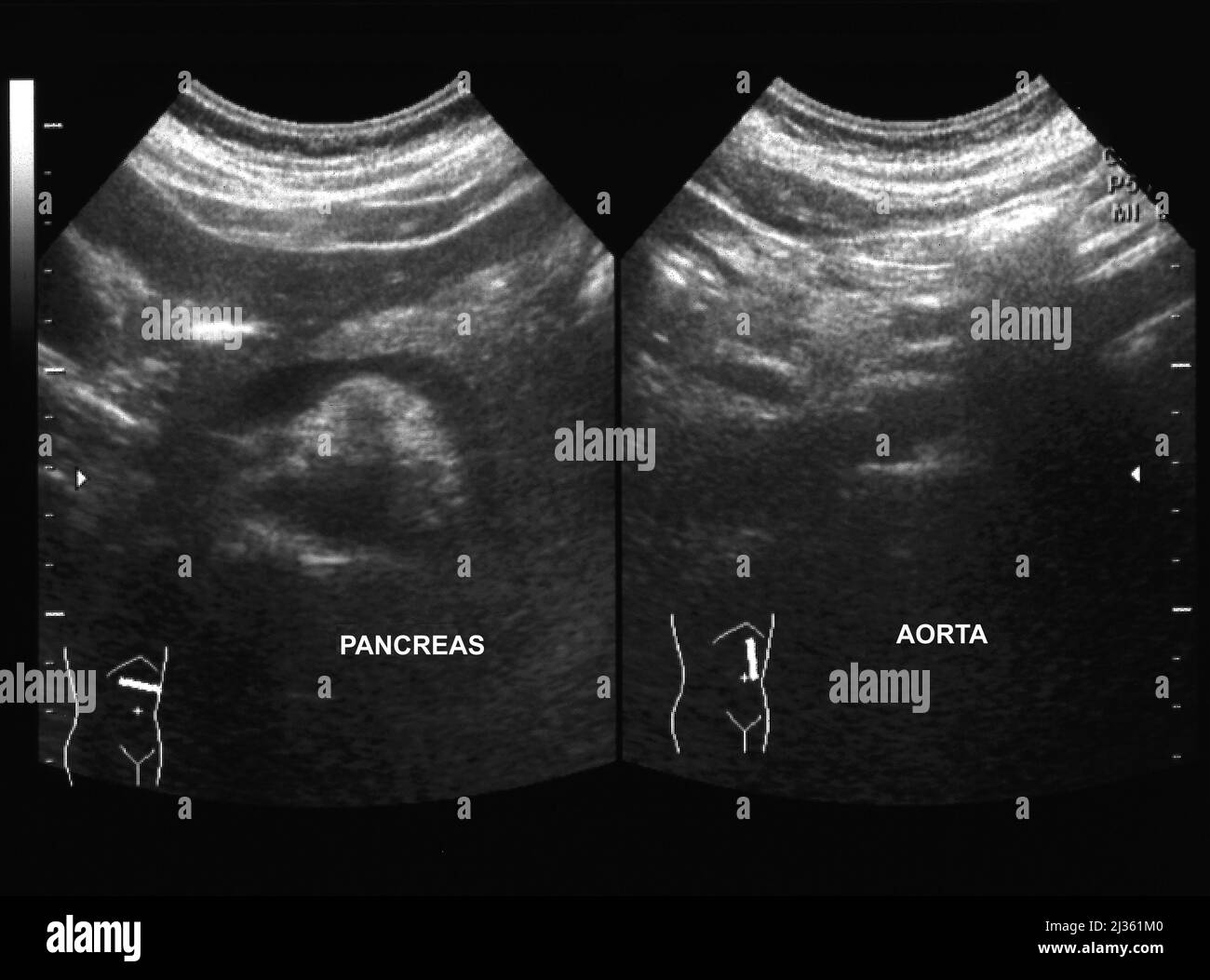 Normal pancreas and aorta, ultrasound scans Stock Photo - Alamy