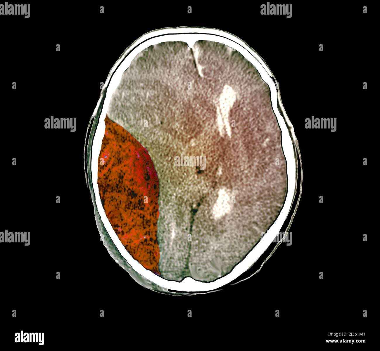 Extradural haematoma, CT scan Stock Photo - Alamy