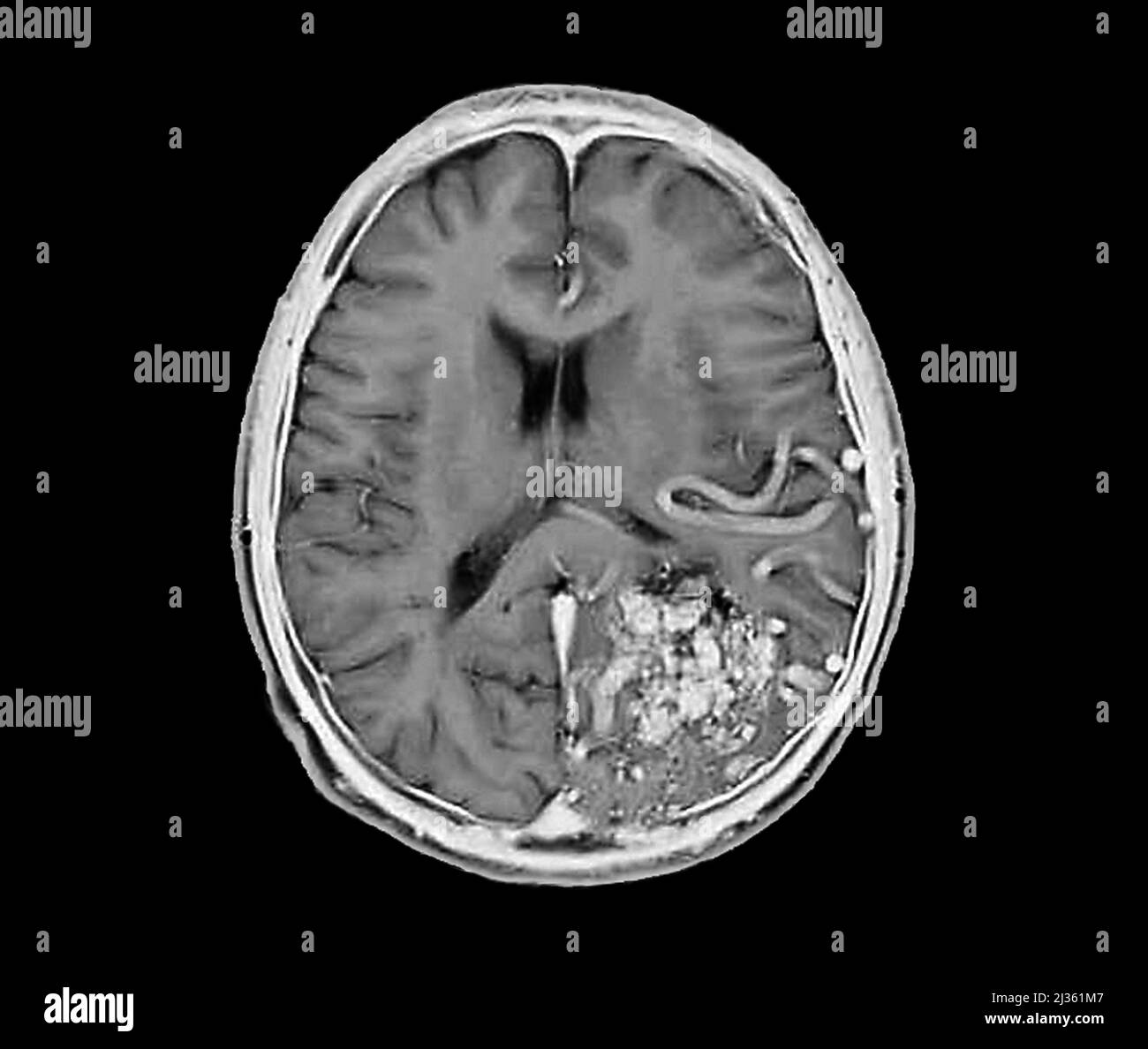 Arteriovenous malformation, MRI scan Stock Photo - Alamy