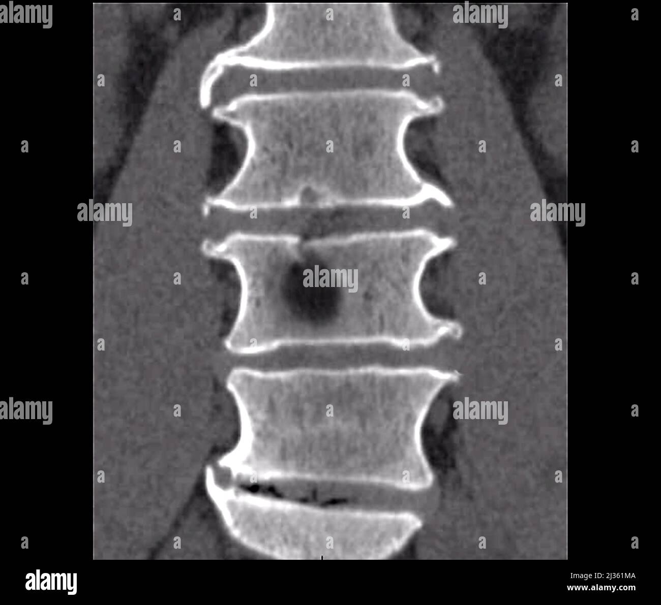 Schmorl's node, CT scan Stock Photo - Alamy
