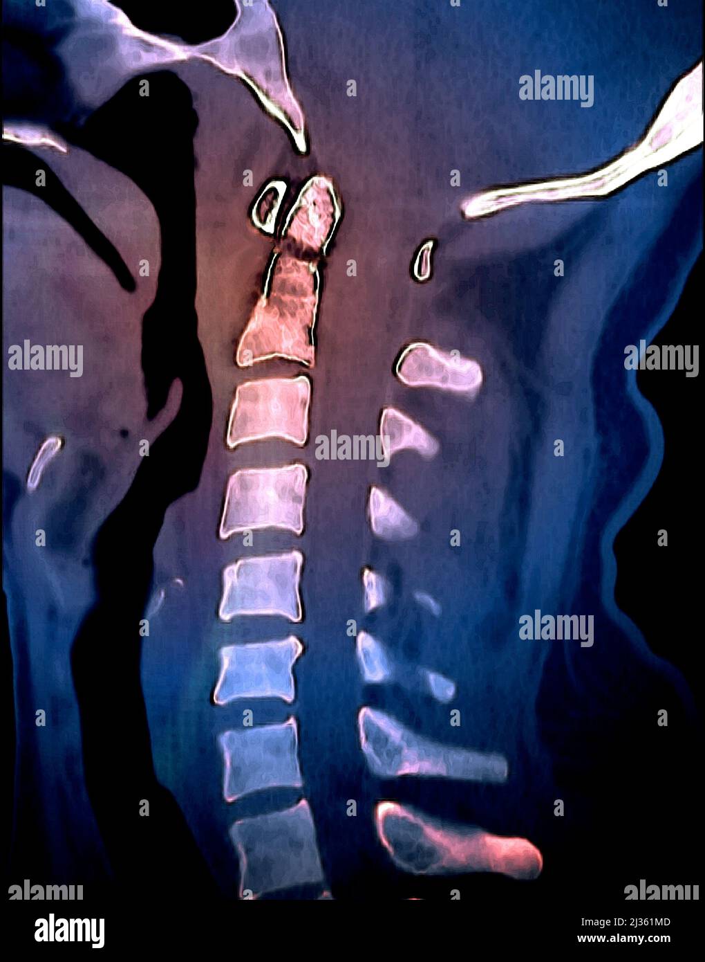 Odontoid process fracture, CT scan Stock Photo - Alamy