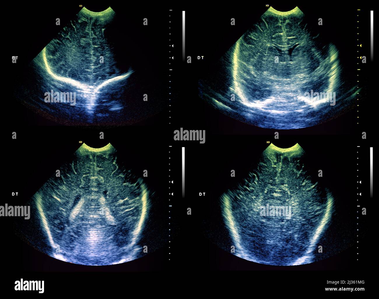 Premature baby normal brain development, ultrasound scan Stock Photo ...