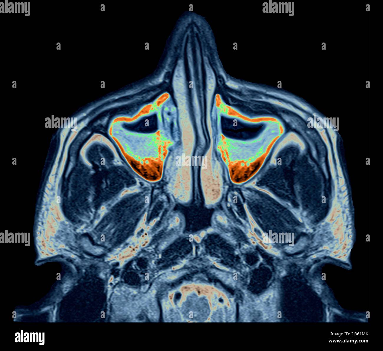 Sinusitis, MRI scan Stock Photo - Alamy