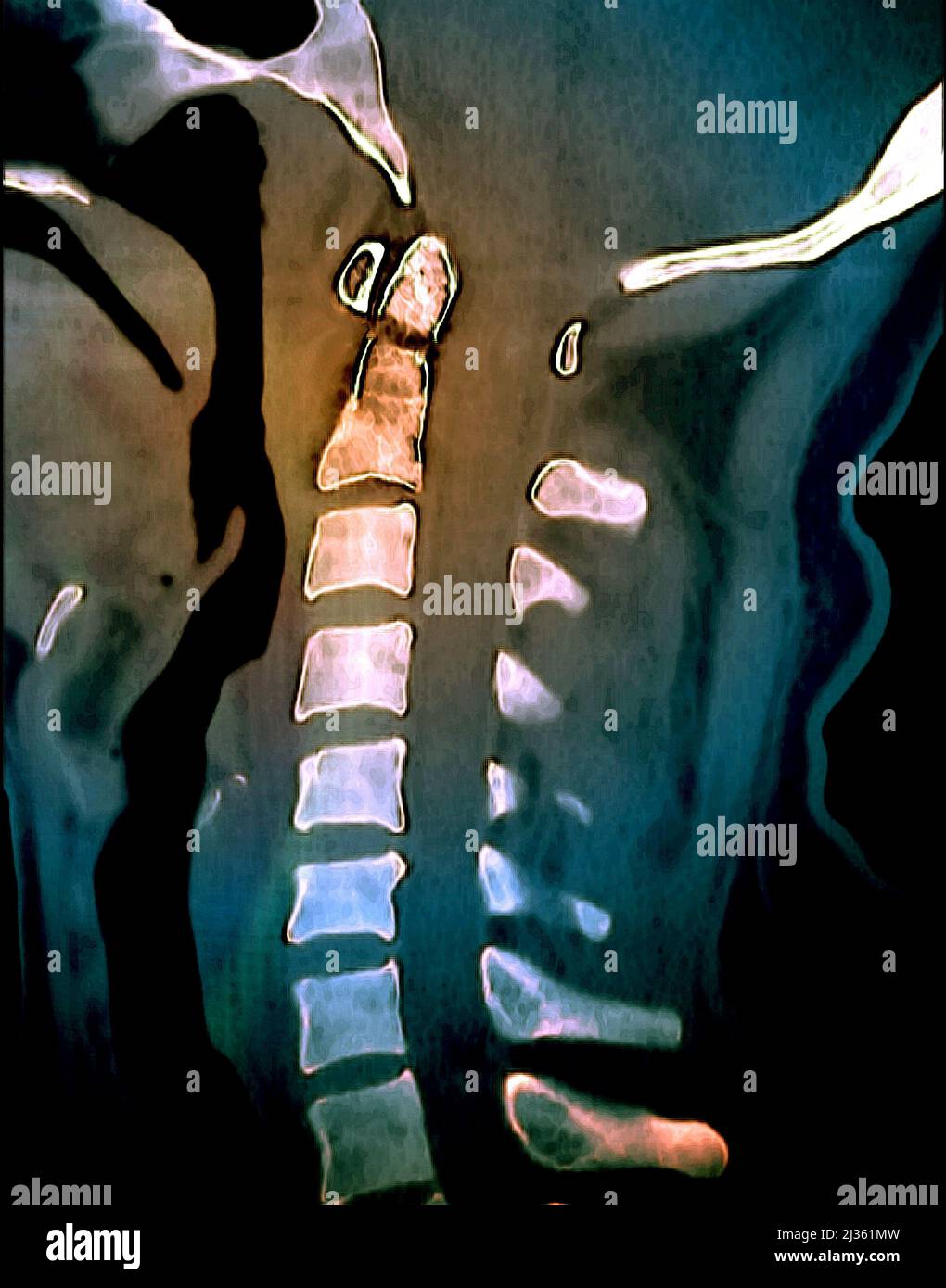 Odontoid process fracture, CT scan Stock Photo - Alamy