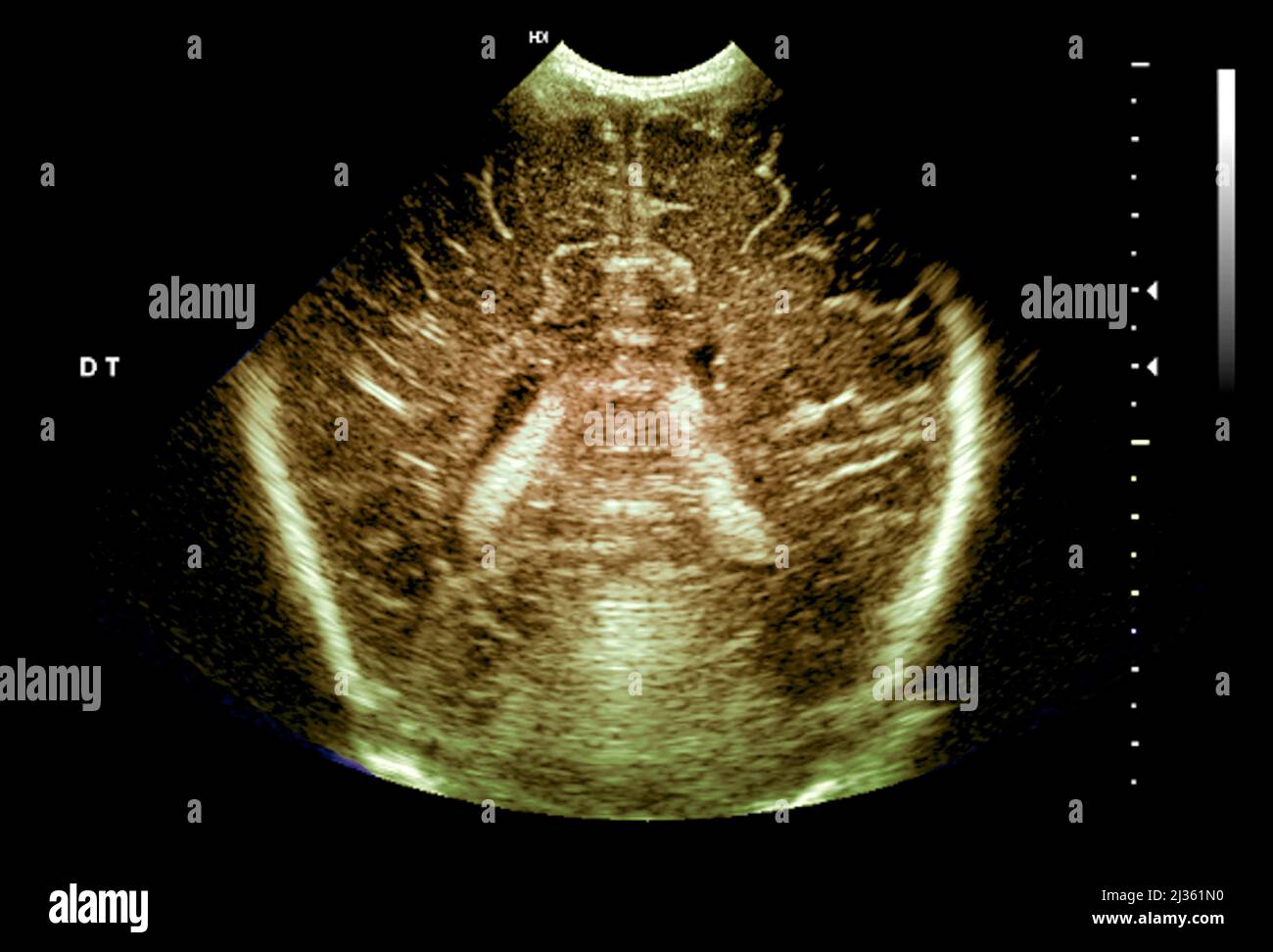Normal premature newborn baby brain development, ultrasound Stock Photo ...