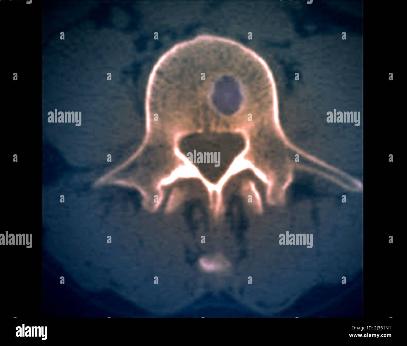 Schmorl's node, CT scan Stock Photo - Alamy