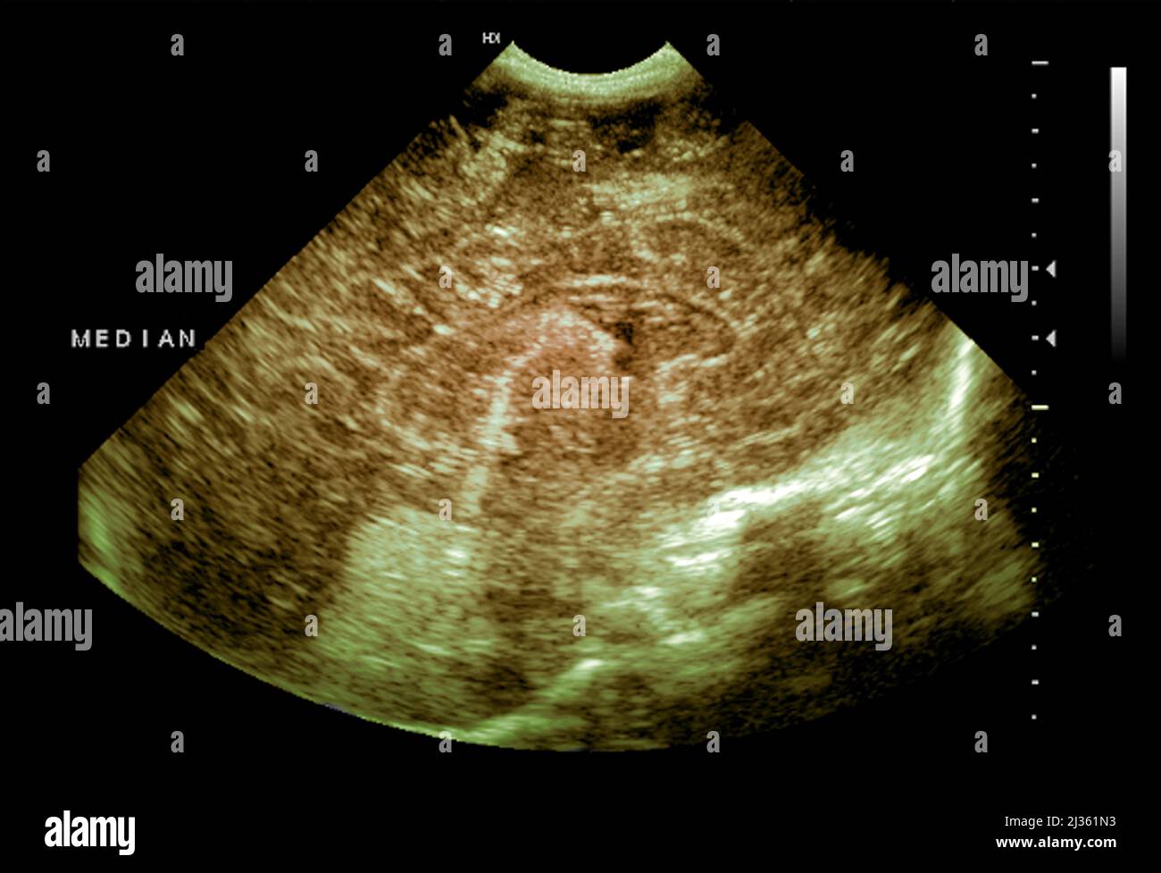 Premature brain normal brain development, ultrasound scan Stock Photo ...