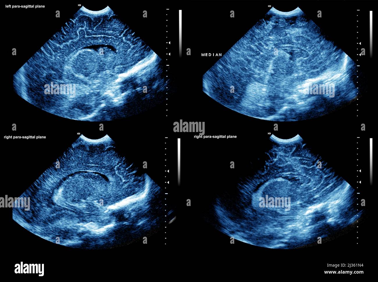 Premature baby normal brain development, ultrasound scans Stock Photo ...