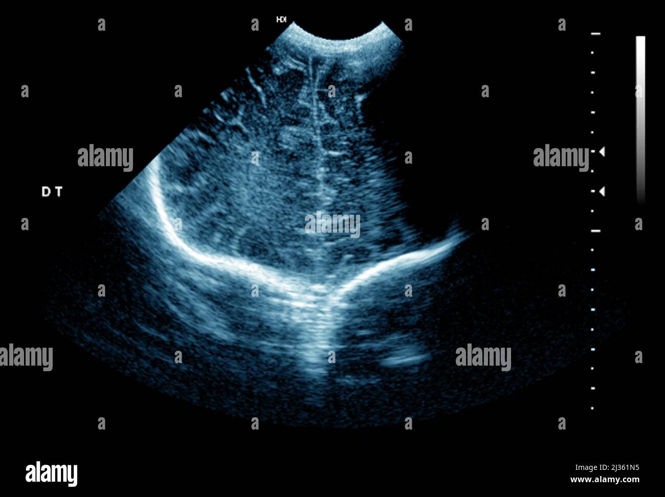 Normal premature newborn baby brain development, ultrasound Stock Photo ...