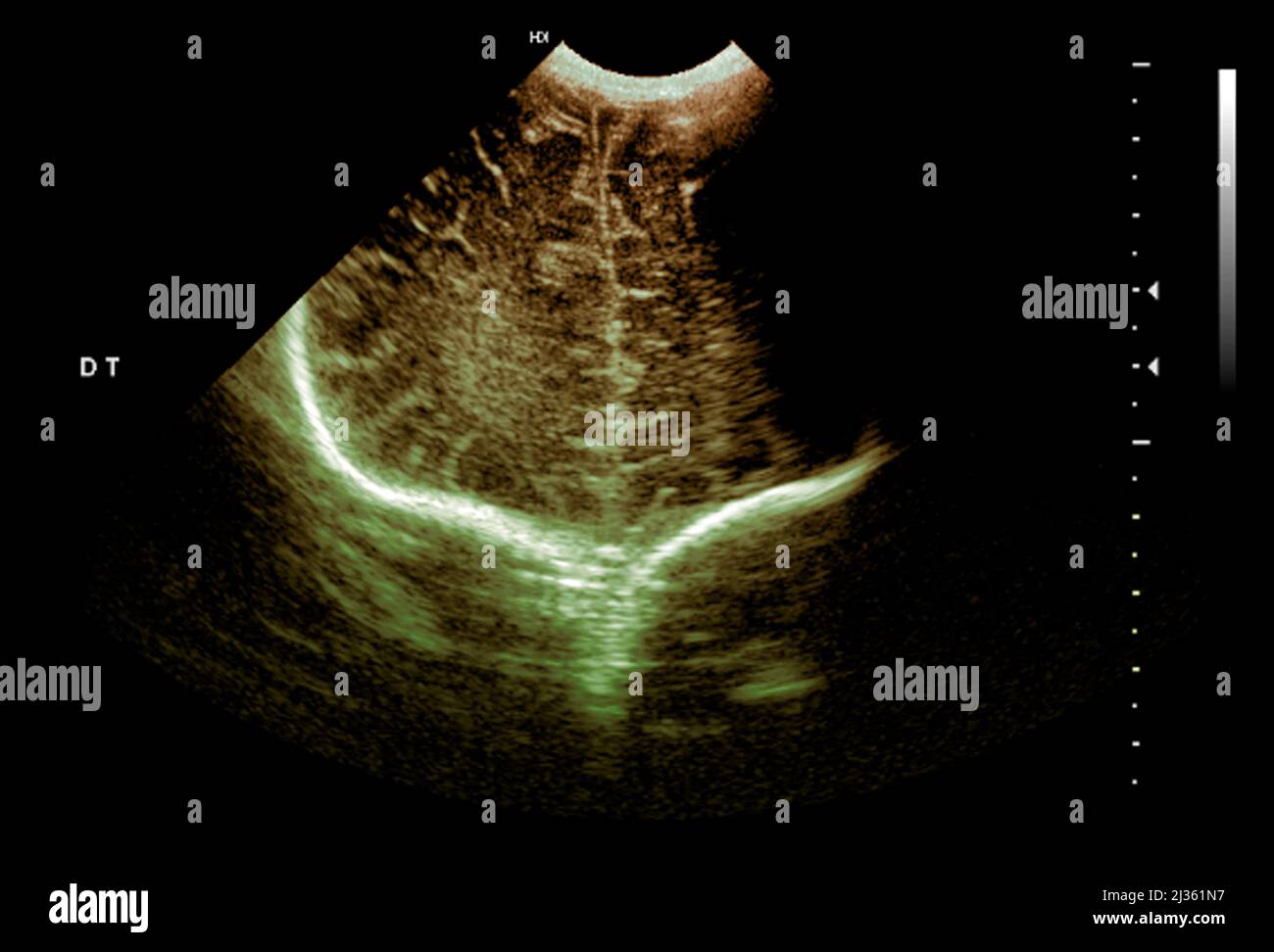 Normal premature newborn baby brain development, ultrasound Stock Photo ...