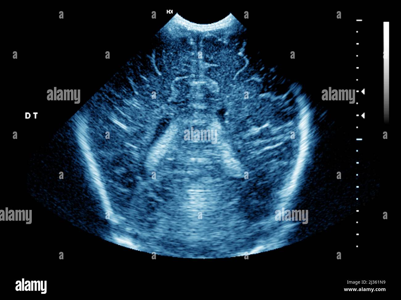 Normal premature newborn baby brain development, ultrasound Stock Photo ...