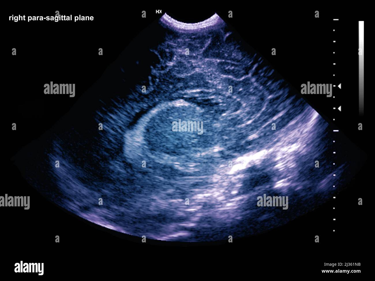 Premature baby normal brain development, ultrasound scans Stock Photo ...