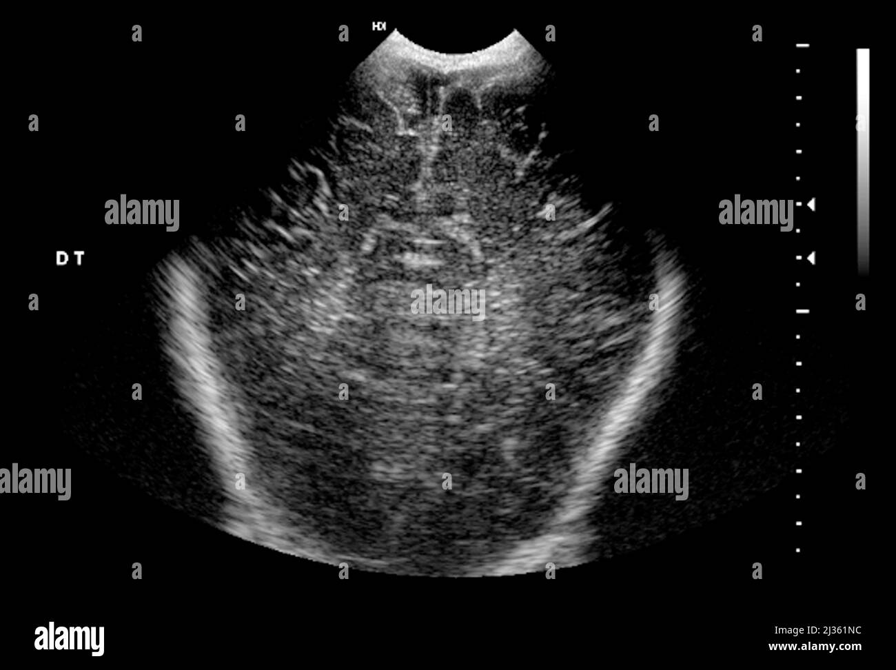 Normal premature newborn baby brain development, ultrasound Stock Photo ...
