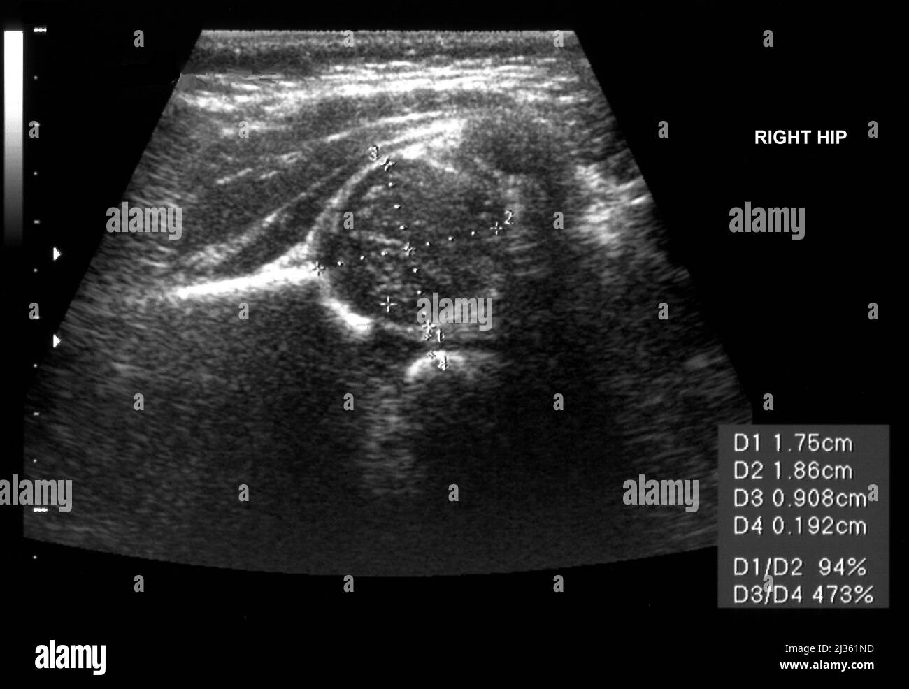 Healthy right hip of a baby, ultrasound scan Stock Photo - Alamy