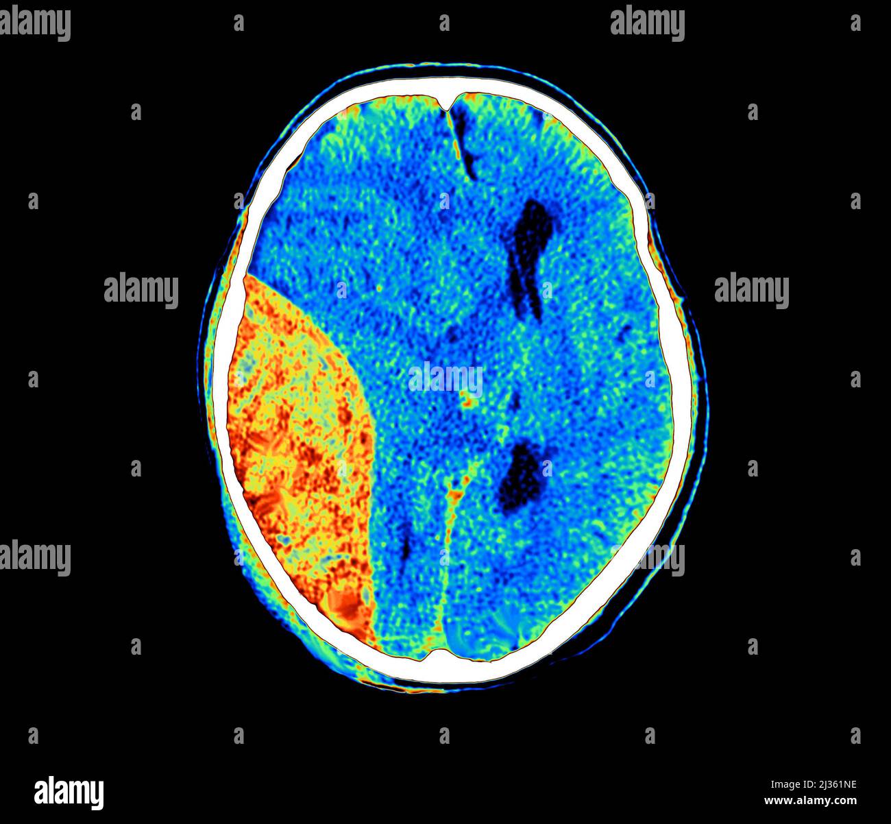 Extradural haematoma, CT scan Stock Photo - Alamy