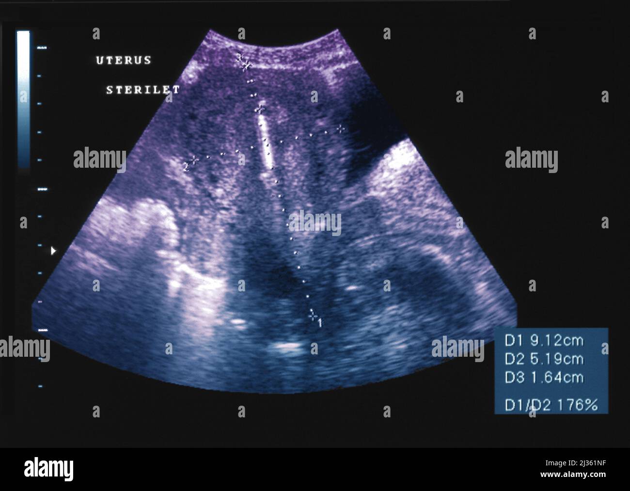 Normal uterus and IUD device, ultrasound scan Stock Photo - Alamy