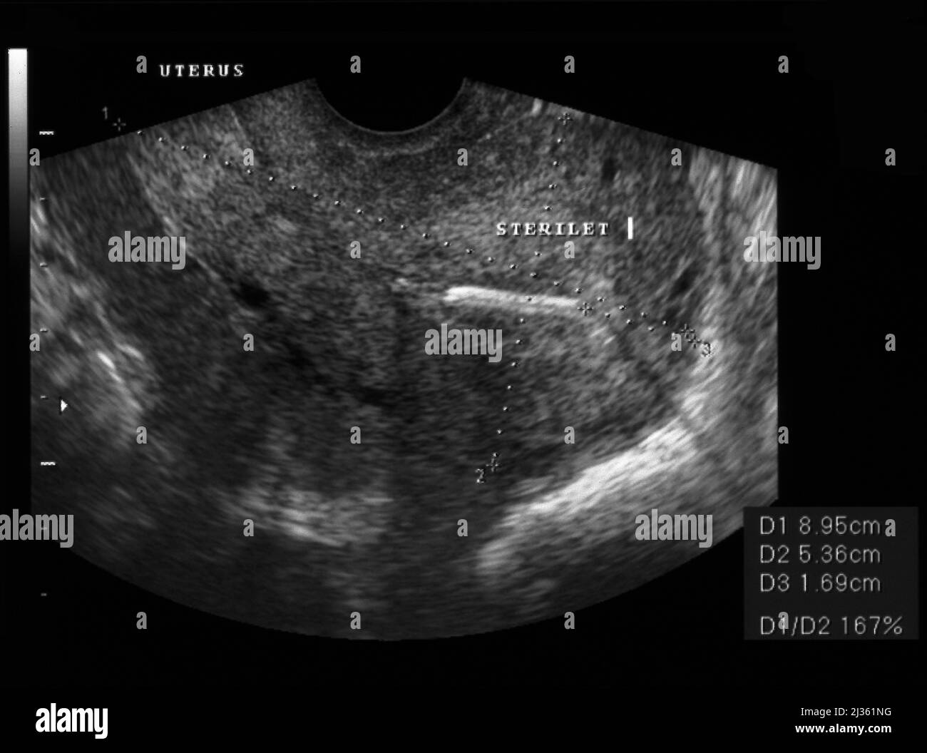 Normal uterus, ultrasound scan Stock Photo - Alamy