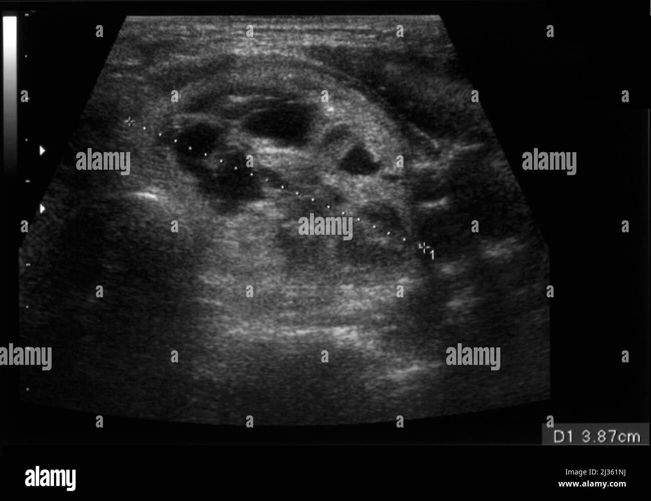 Thyroid nodule, ultrasound scan Stock Photo - Alamy