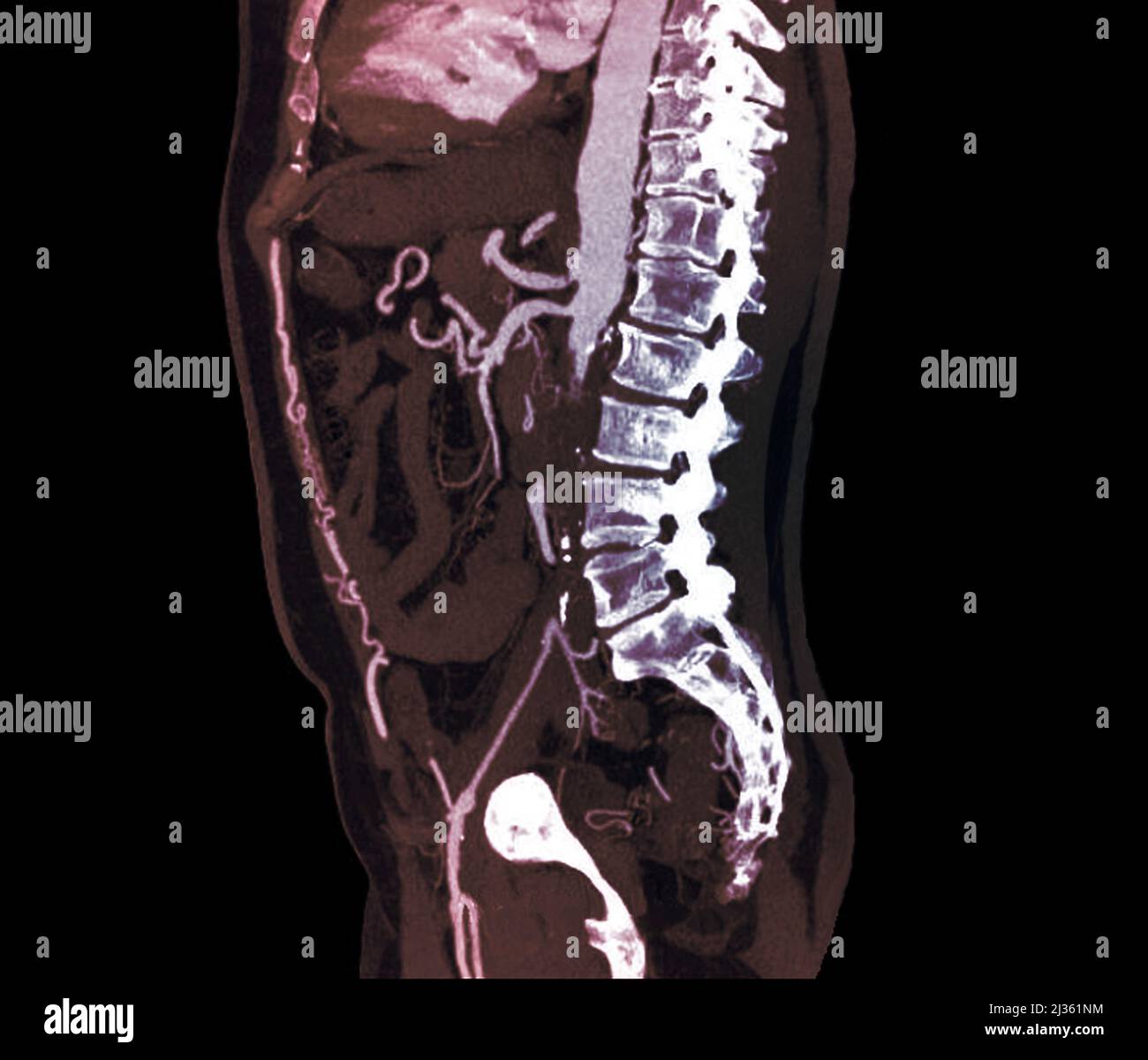 Aortoiliac occlusive disease, CT angiogram Stock Photo - Alamy
