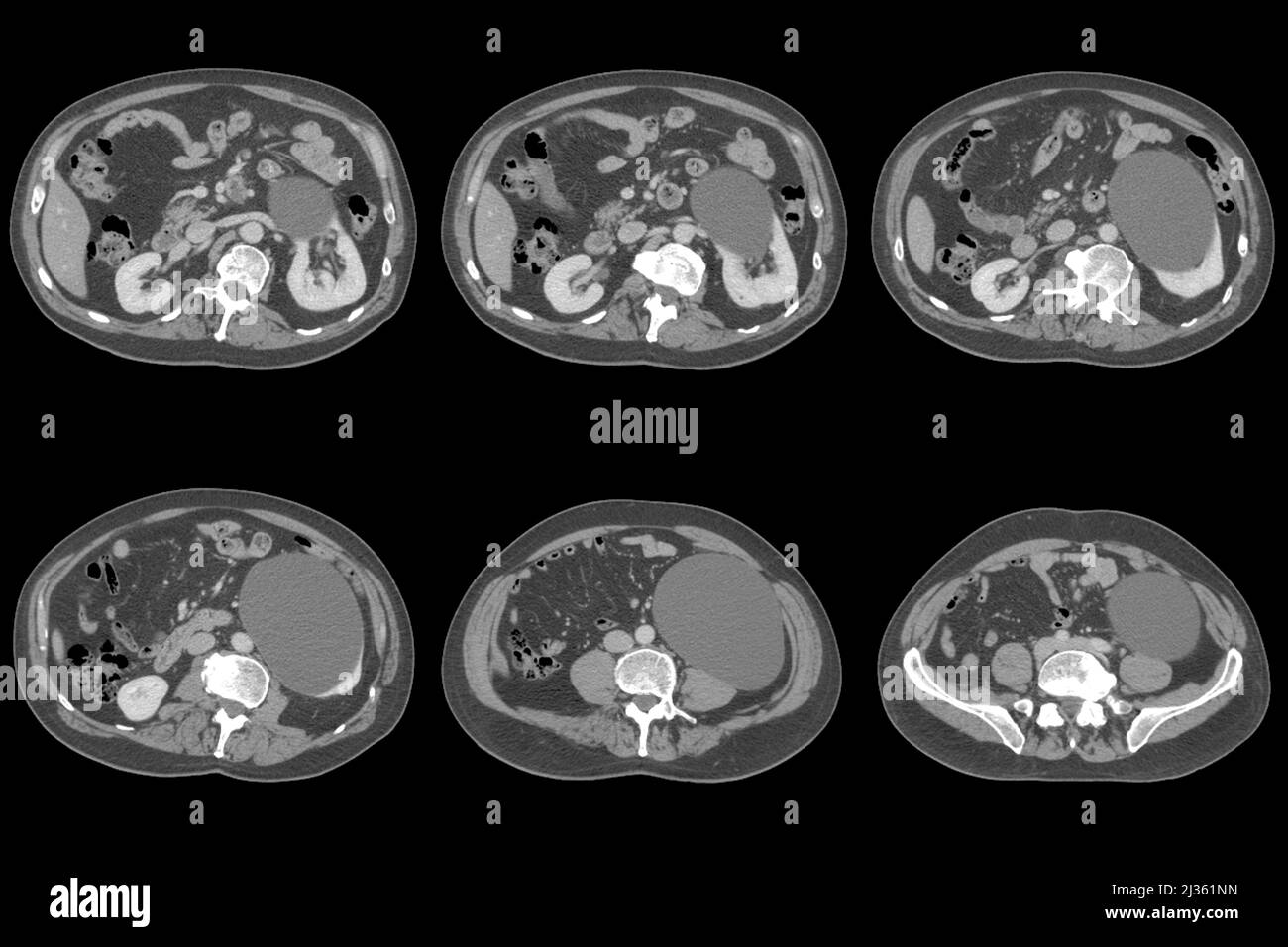 Kidney cyst, CT scans Stock Photo - Alamy
