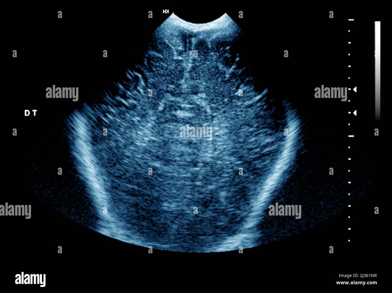 Normal premature newborn baby brain development, ultrasound Stock Photo ...