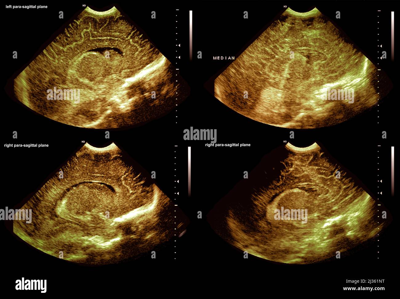 Premature baby normal brain development, ultrasound scans Stock Photo ...