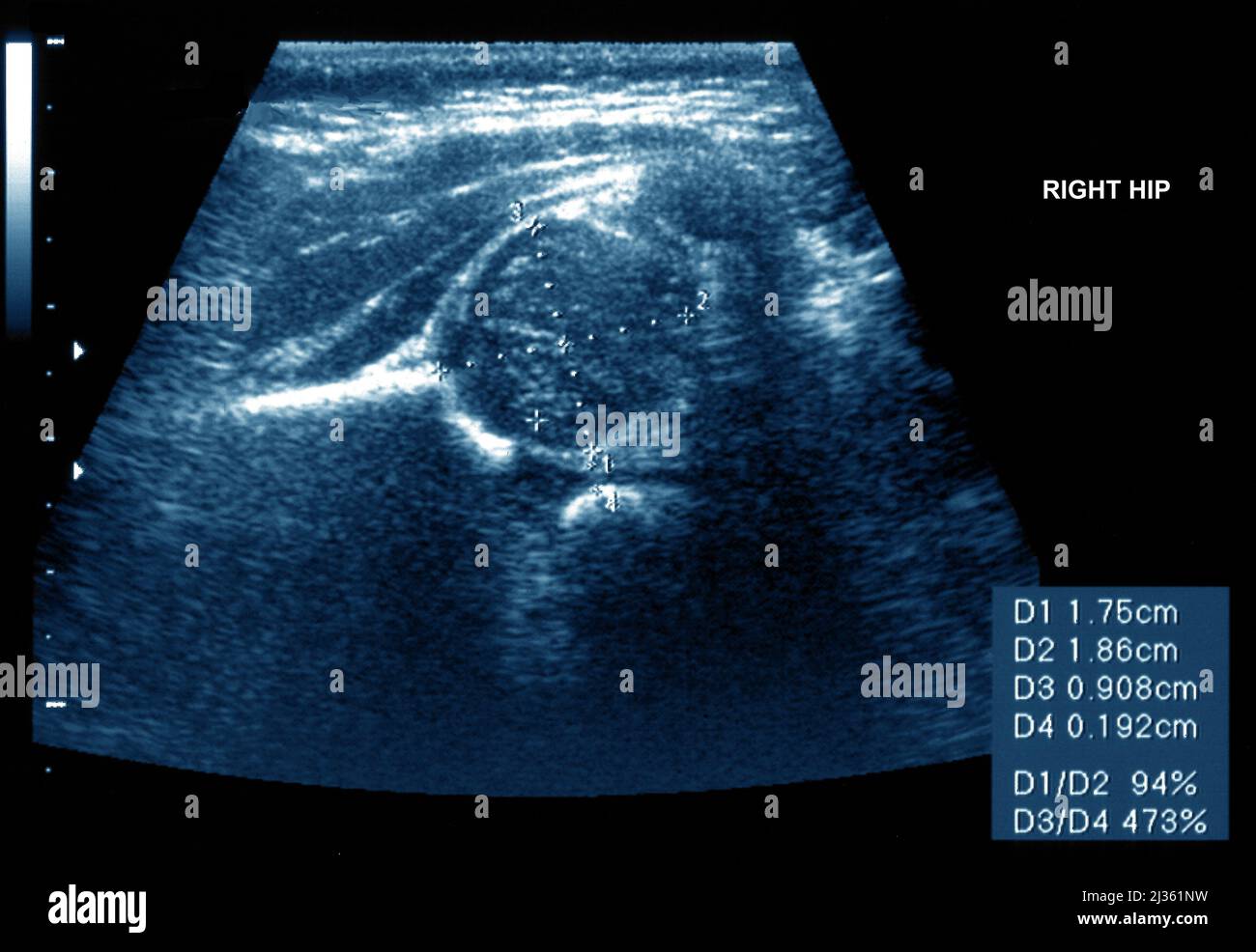 Healthy right hip of a baby, ultrasound scan Stock Photo - Alamy